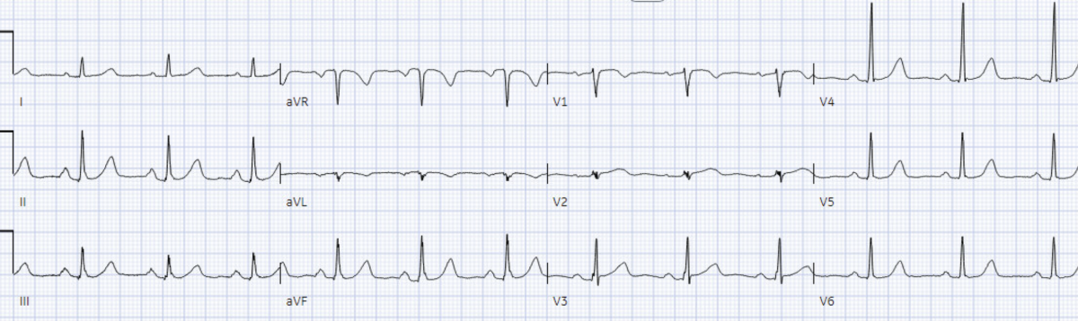 ECG artifact and lead misplacement | ECG Cases | EM Cases