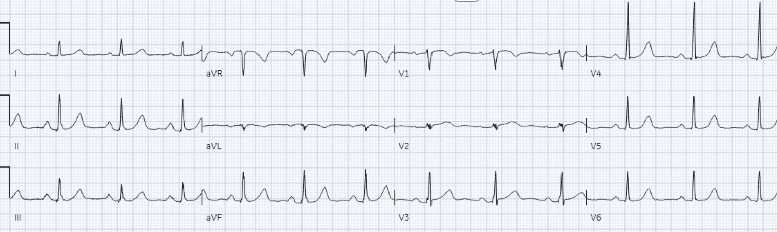 ECG artifact and lead misplacement | ECG Cases | EM Cases