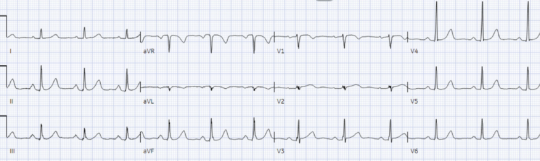 ECG artifact and lead misplacement | ECG Cases | EM Cases