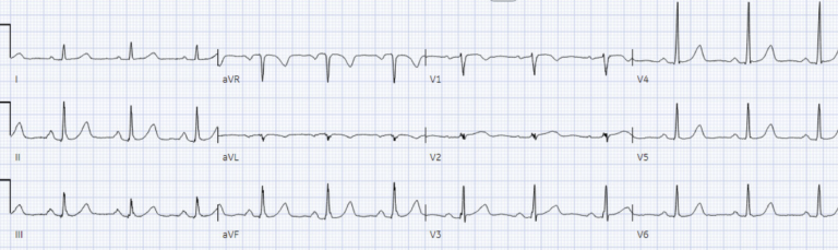 ECG artifact and lead misplacement | ECG Cases | EM Cases