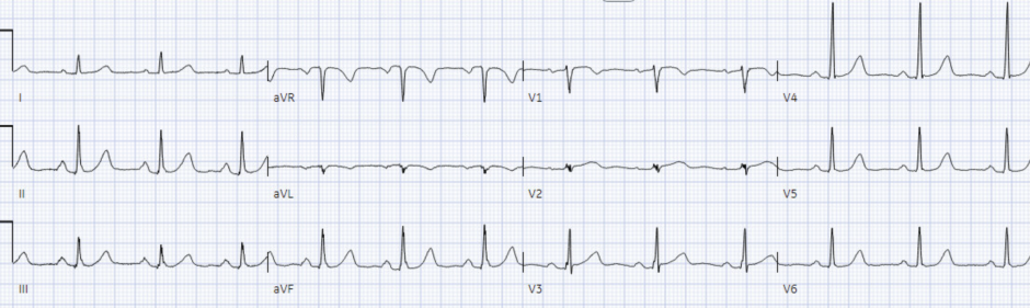 ECG artifact and lead misplacement | ECG Cases | EM Cases