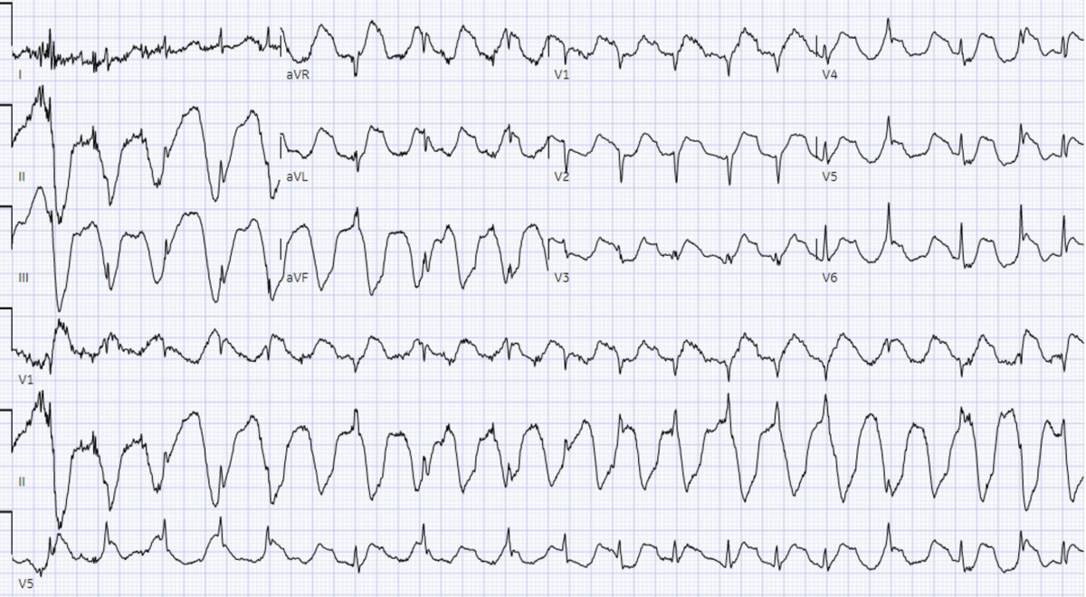 ECG artifact and lead misplacement | ECG Cases | EM Cases
