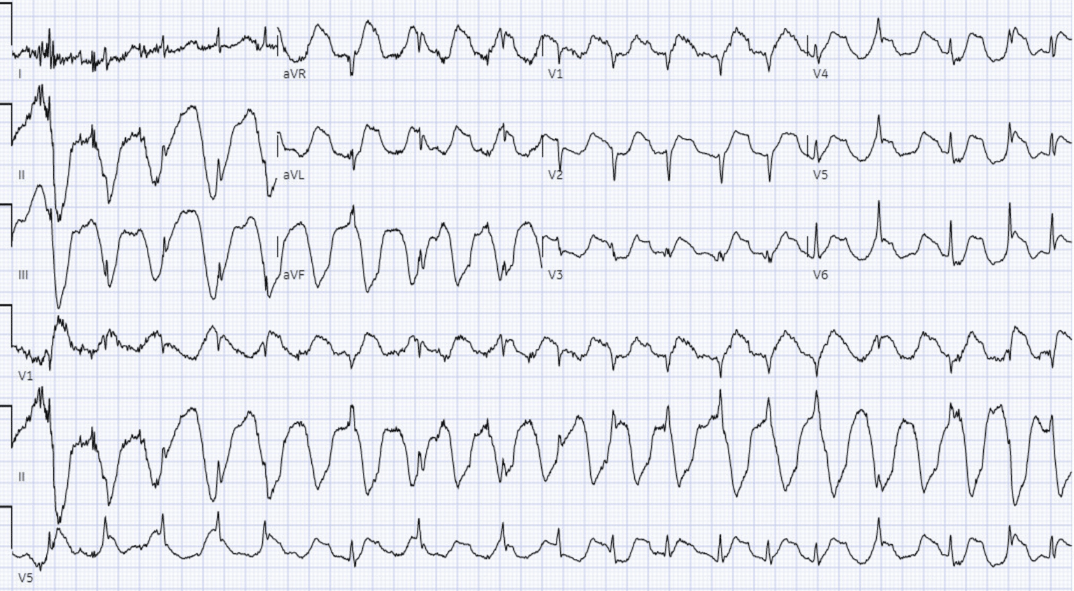 ECG artifact and lead misplacement | ECG Cases | EM Cases