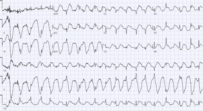 ECG artifact and lead misplacement | ECG Cases | EM Cases