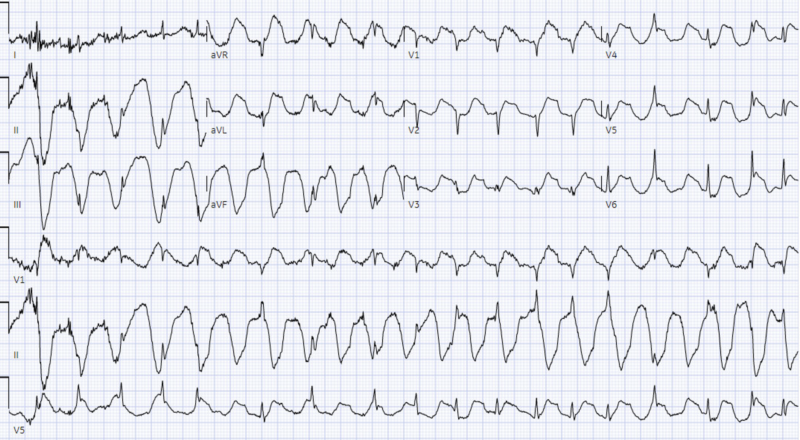 ECG artifact and lead misplacement | ECG Cases | EM Cases