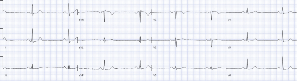 ECG artifact and lead misplacement | ECG Cases | EM Cases