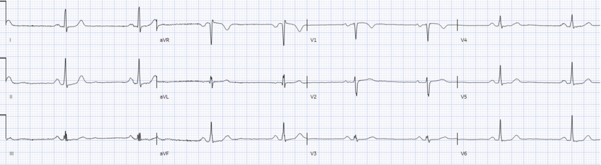 ECG artifact and lead misplacement | ECG Cases | EM Cases