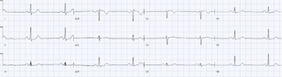 ECG artifact and lead misplacement | ECG Cases | EM Cases