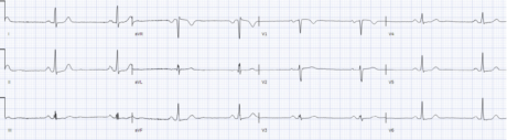 ECG artifact and lead misplacement | ECG Cases | EM Cases