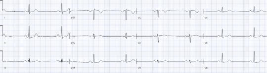 ECG artifact and lead misplacement | ECG Cases | EM Cases