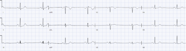 ECG artifact and lead misplacement | ECG Cases | EM Cases