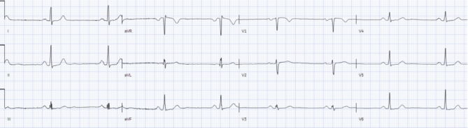 ECG artifact and lead misplacement | ECG Cases | EM Cases