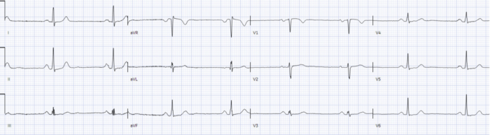 ECG artifact and lead misplacement | ECG Cases | EM Cases