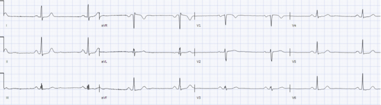 ECG artifact and lead misplacement | ECG Cases | EM Cases