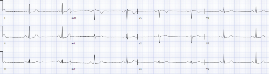 ECG artifact and lead misplacement | ECG Cases | EM Cases