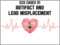 ECG artifact and lead misplacement | ECG Cases | EM Cases
