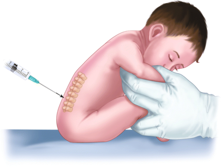 Pediatric Meningitis Recognition, Workup & Management | EM Cases podcast