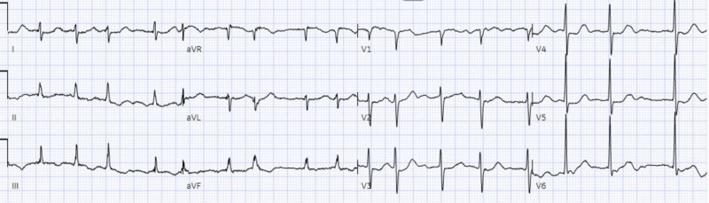 ECG artifact and lead misplacement | ECG Cases | EM Cases