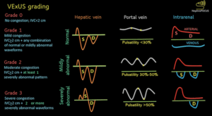 Acute Heart Failure Risk Stratification & Disposition | Emergency ...