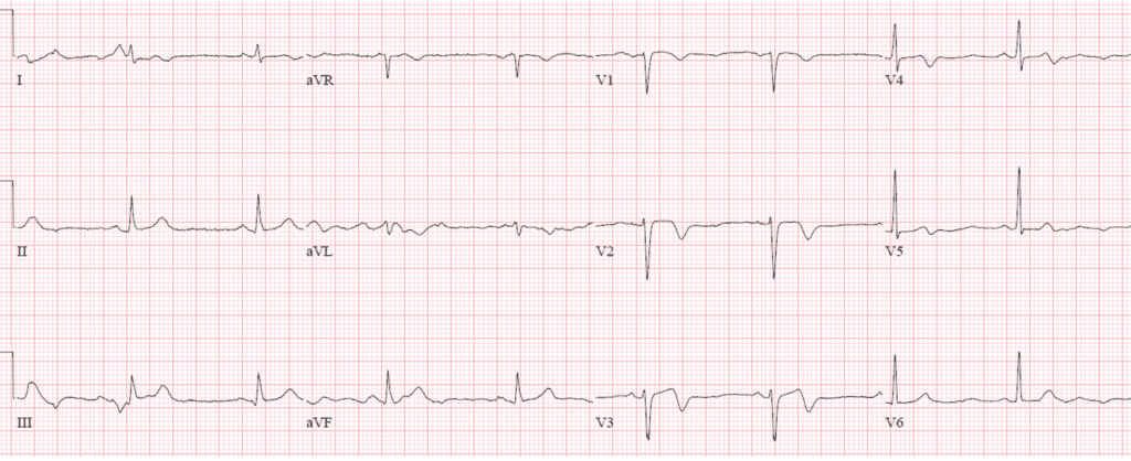ECGs falsely labeled normal | ECG Cases | EM Cases