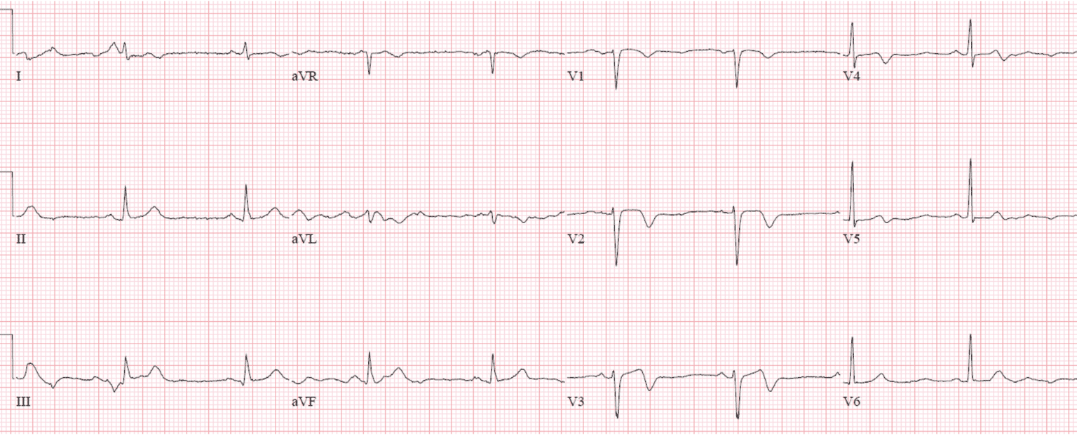 ECGs falsely labeled normal | ECG Cases | EM Cases