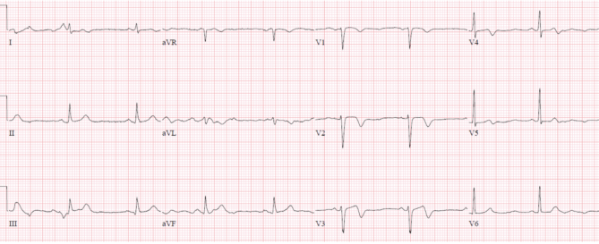 ECGs falsely labeled normal | ECG Cases | EM Cases