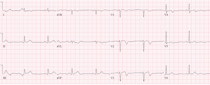 ECGs falsely labeled normal | ECG Cases | EM Cases