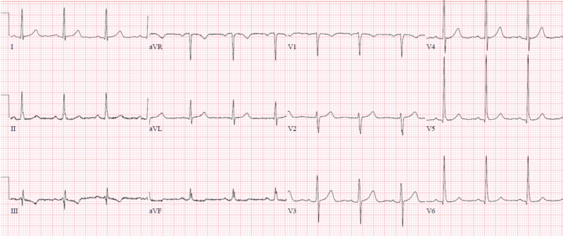 ECGs falsely labeled normal | ECG Cases | EM Cases