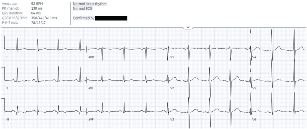 ECGs falsely labeled normal | ECG Cases | EM Cases