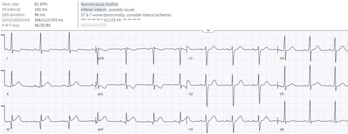 ECGs falsely labeled normal | ECG Cases | EM Cases