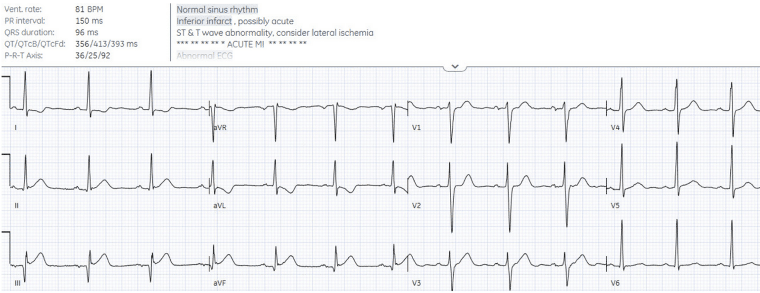ECGs falsely labeled normal | ECG Cases | EM Cases