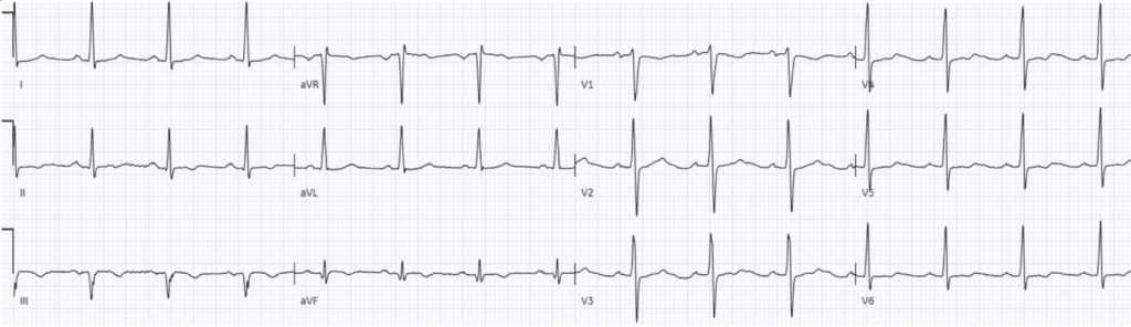 ECGs falsely labeled normal | ECG Cases | EM Cases