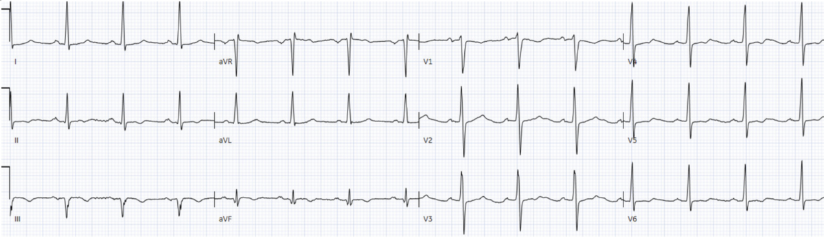 ECGs falsely labeled normal | ECG Cases | EM Cases