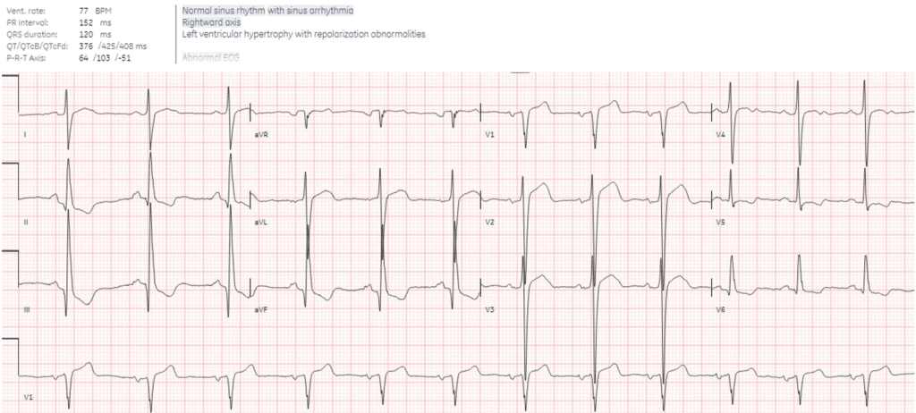 The Art of Occlusion MI: Mirror Image | ECG Cases | Emergency Medicine Cases