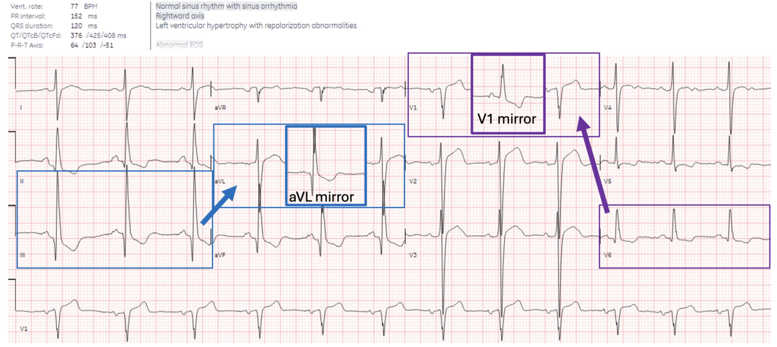 The Art of Occlusion MI: Mirror Image | ECG Cases | Emergency Medicine ...