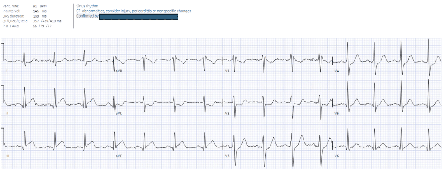 The Art of Occlusion MI: Mirror Image | ECG Cases | Emergency Medicine ...