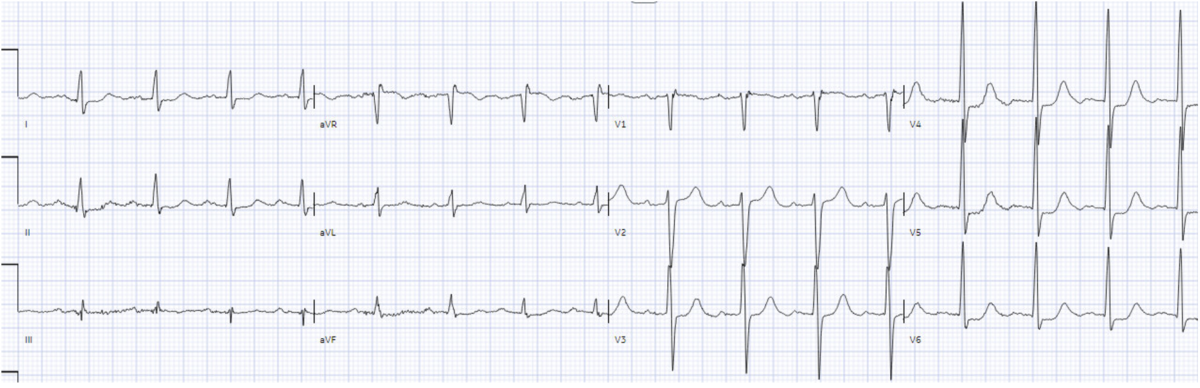 The Art of Occlusion MI: Mirror Image | ECG Cases | Emergency Medicine ...