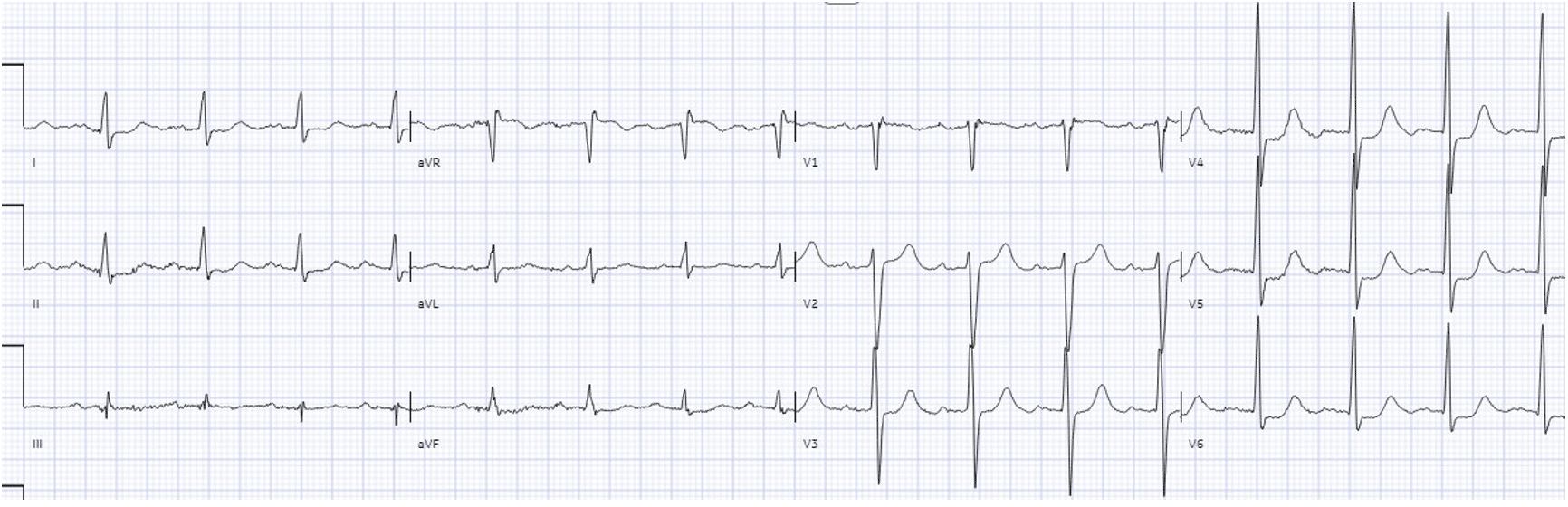 The Art of Occlusion MI: Mirror Image | ECG Cases | Emergency Medicine ...