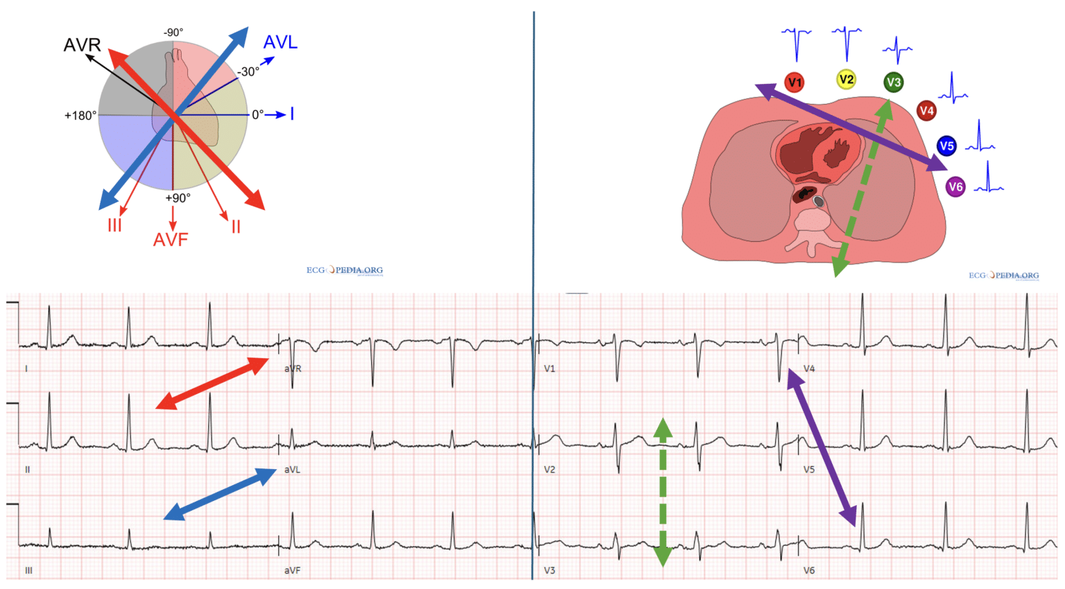 The Art of Occlusion MI: Mirror Image | ECG Cases | Emergency Medicine ...
