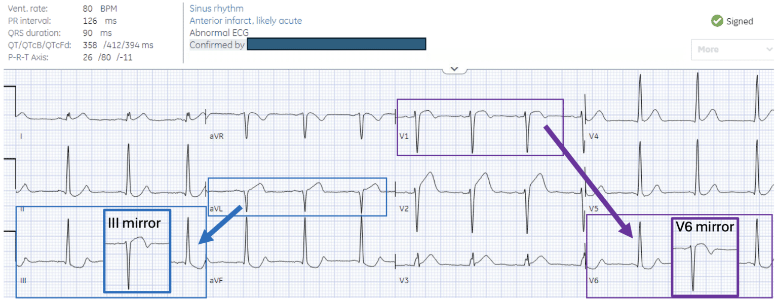 The Art of Occlusion MI: Mirror Image | ECG Cases | Emergency Medicine ...