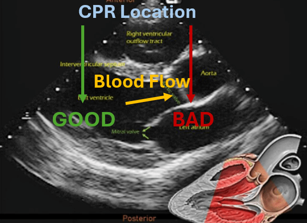 TEE in Cardiac Arrest, Nebulized Ketamine, SQ Insulin for DKA | EM ...