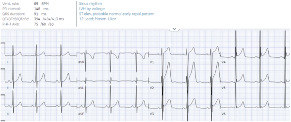 The Art of Occlusion MI: Scale and Proportionality | ECG Cases | EM Cases