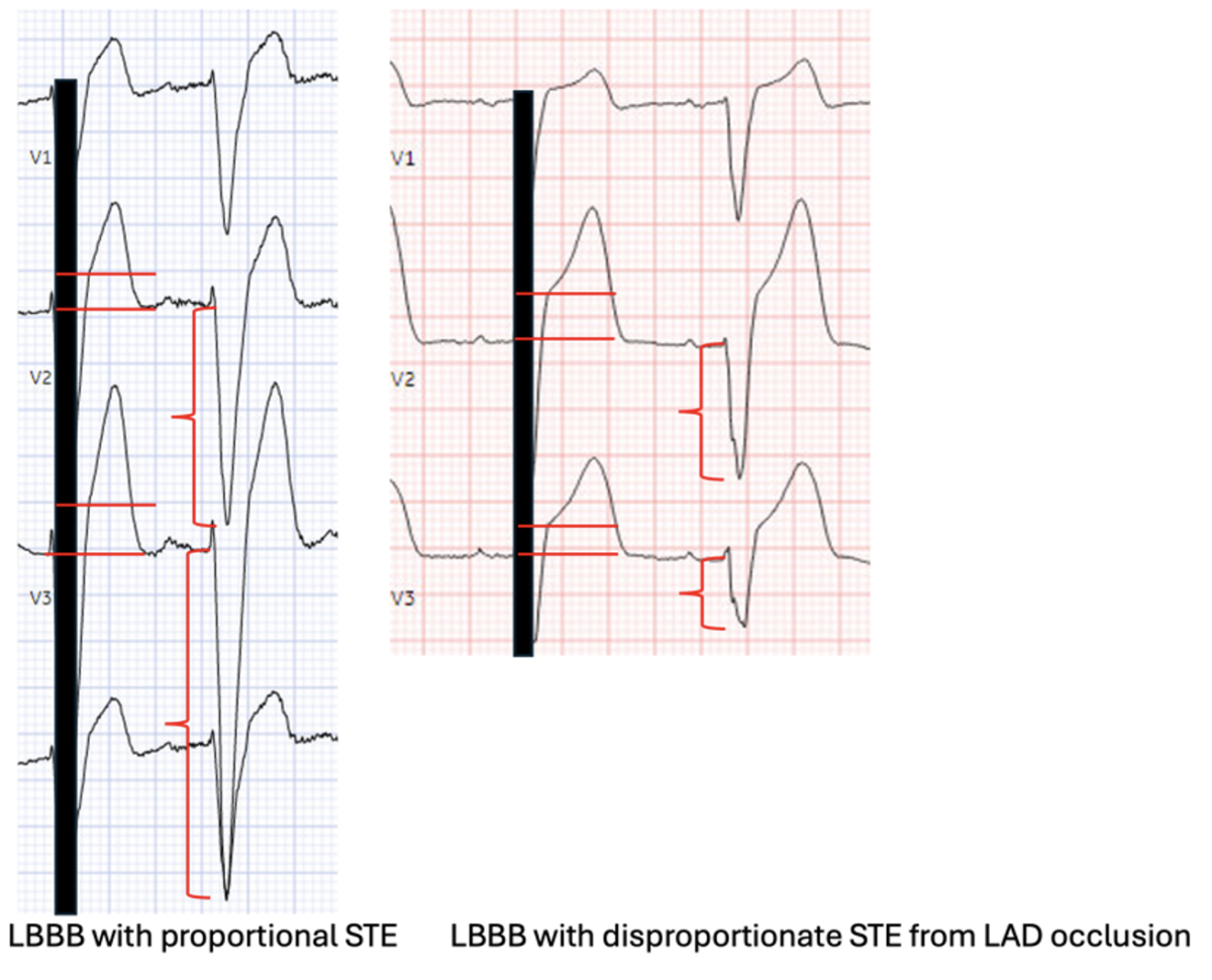 The Art of Occlusion MI: Scale and Proportionality | ECG Cases | EM Cases