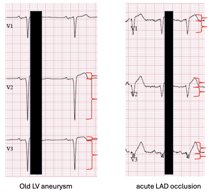 The Art of Occlusion MI: Scale and Proportionality | ECG Cases | EM Cases
