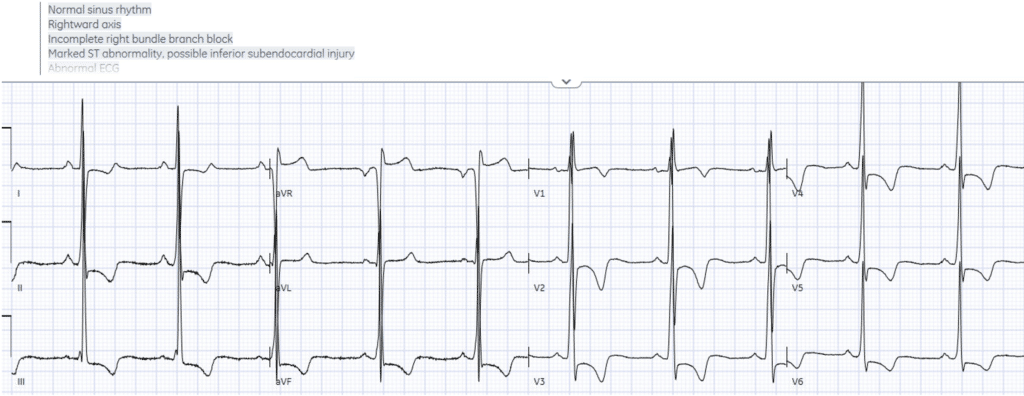 The Art of Occlusion MI, part 3: Impression | ECG Cases | Emergency ...