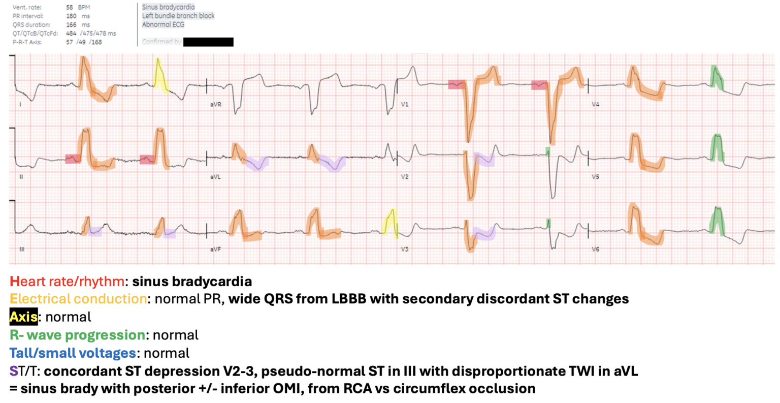 The Art of Occlusion MI, part 3: Impression | ECG Cases | Emergency ...