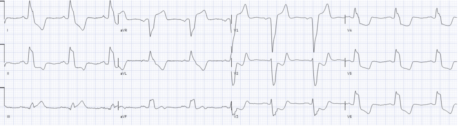 The Art of Occlusion MI, part 3: Impression | ECG Cases | Emergency ...