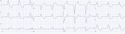 The Art of Occlusion MI, part 3: Impression | ECG Cases | Emergency ...