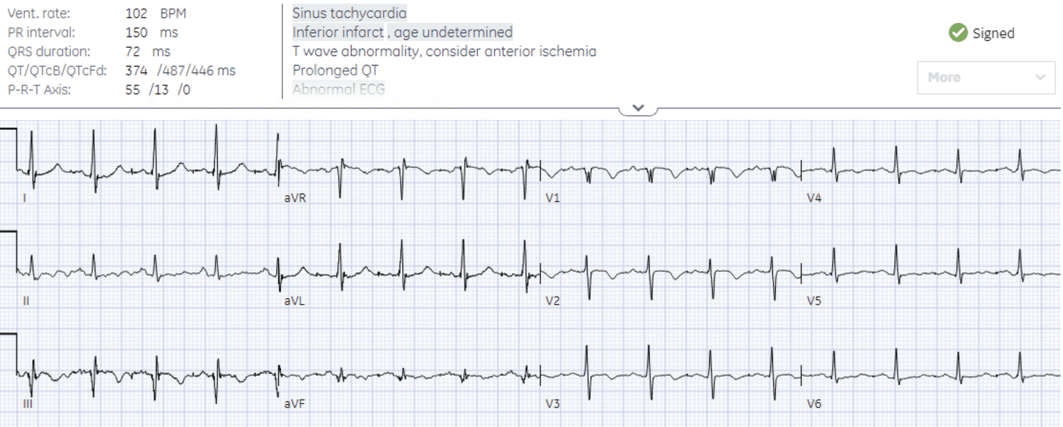 The Art of Occlusion MI, part 3: Impression | ECG Cases | Emergency ...