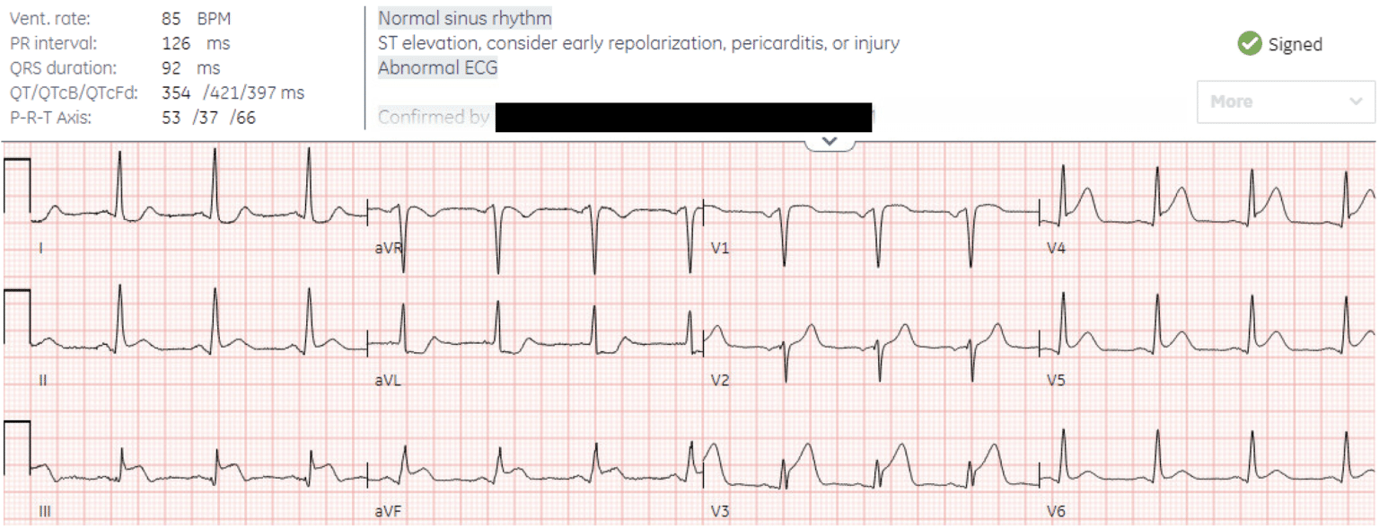 The Art of Occlusion MI, part 3: Impression | ECG Cases | Emergency ...